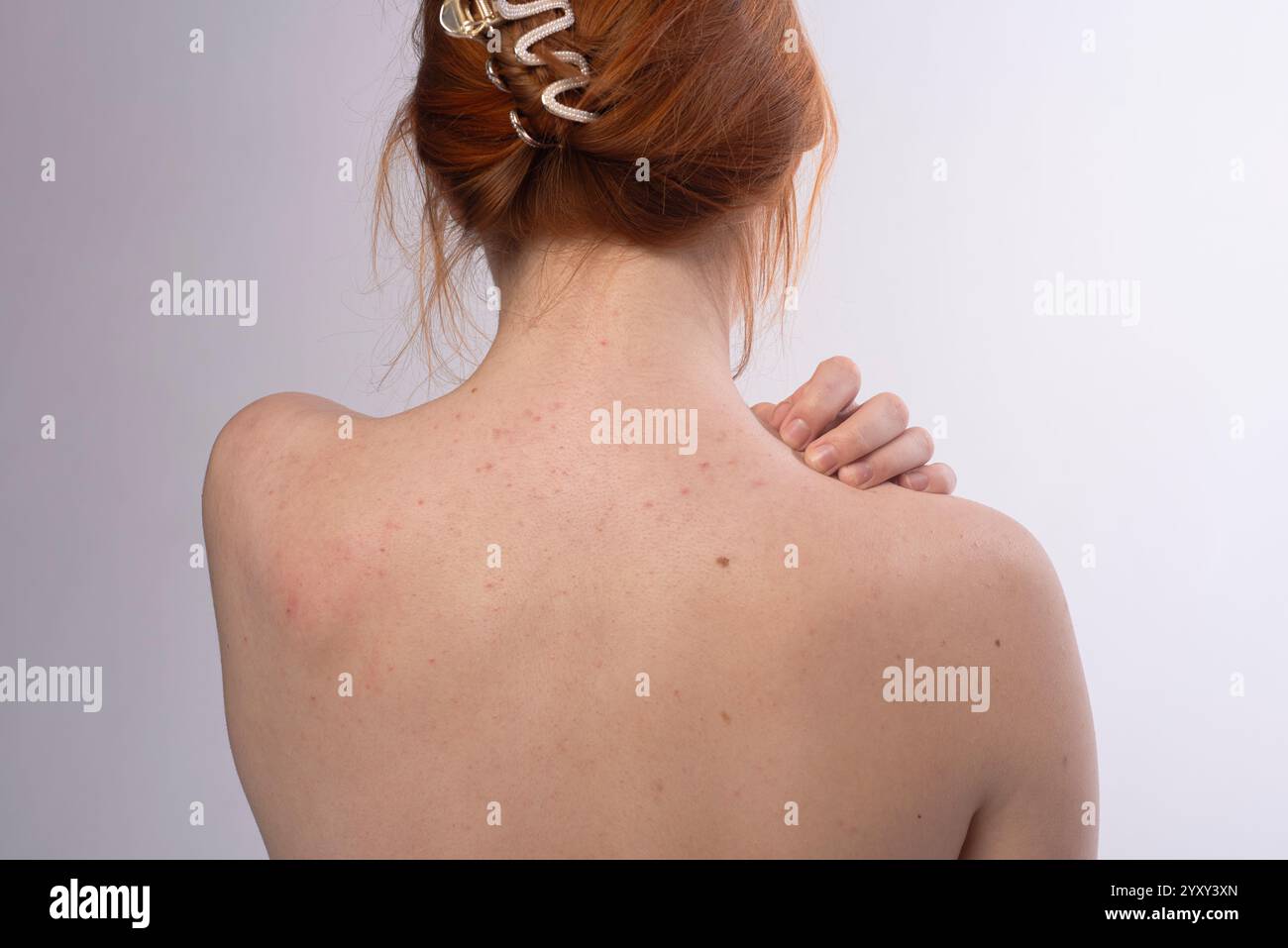 Sensitive skin. Acne skin. Skin acne background. Acne problem on back ...