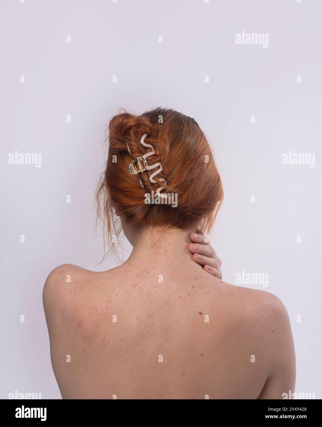 Skin acne, pimples background. Acne problem on back. Dermatology and ...