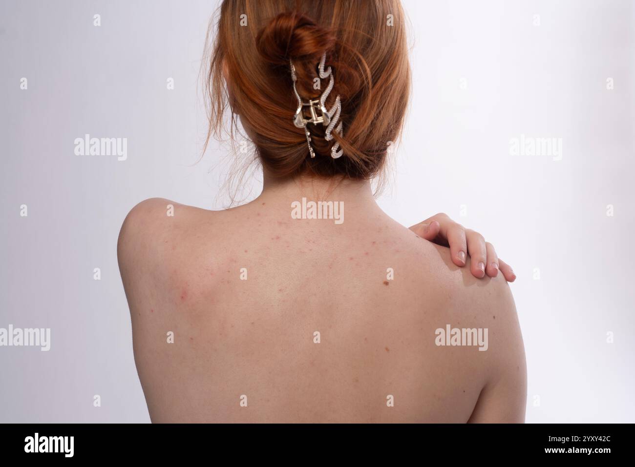 Skin acne background. Pimples on back. Acne problem on back ...