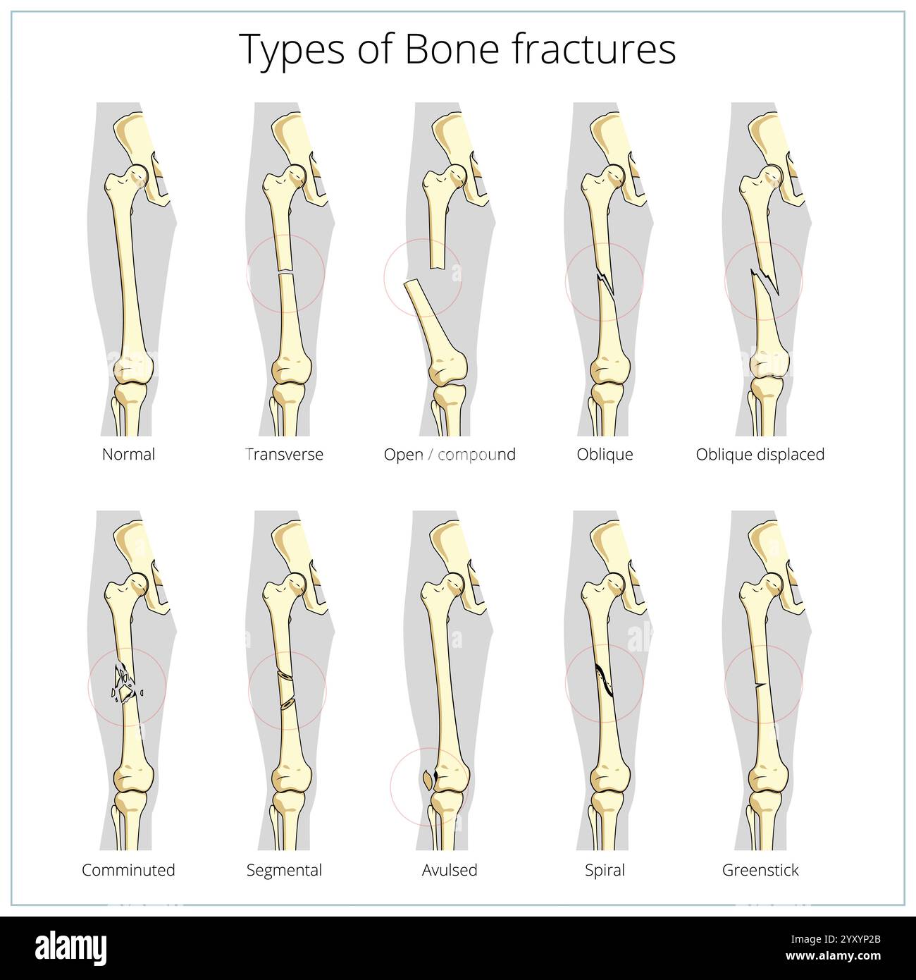 Types of bone fractures medical educational vector Stock Vector Image ...
