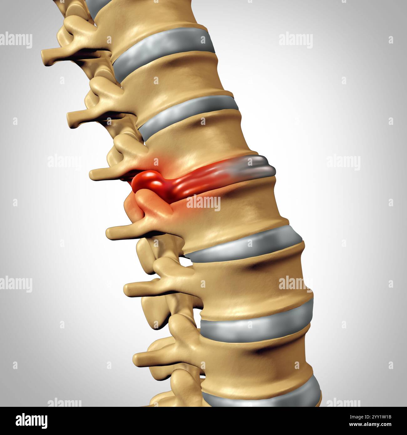 Herniated Disk Spine Disorders as slipped or ruptured disks resulting ...