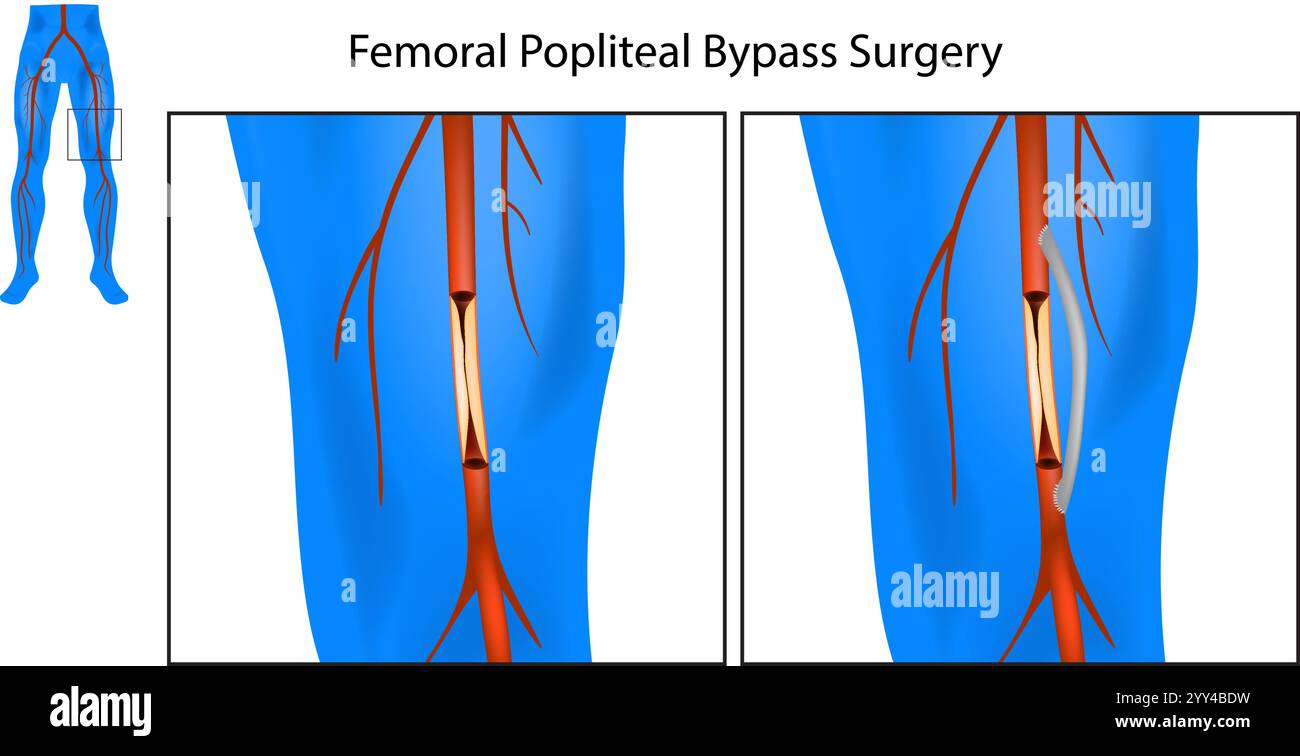 Femoral Popliteal Bypass Surgery Leg Artery Bypass Surgery Diagram Medical Chart Of The