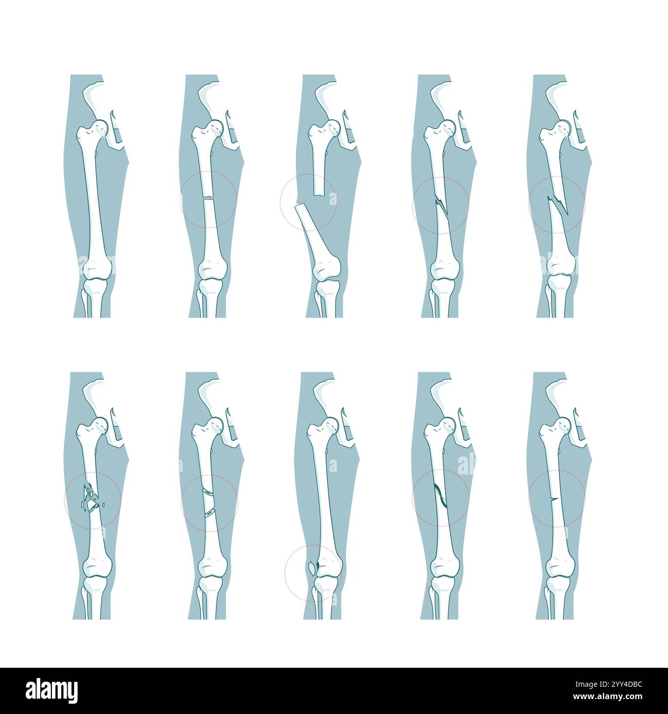 Types of bone fractures medical educational vector Stock Vector Image & Art - Alamy