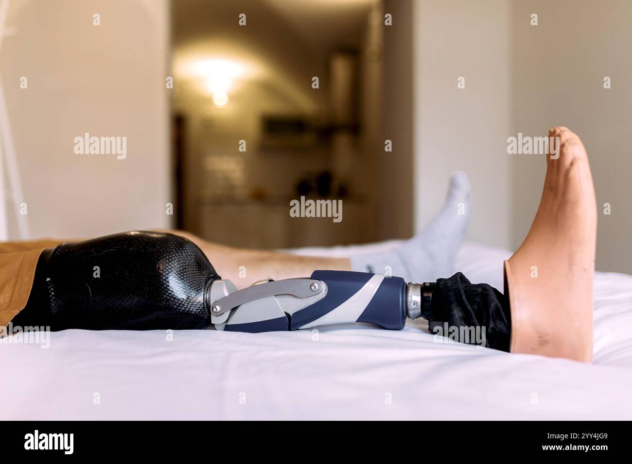 Close-up of a modern prosthetic leg resting on a bed, showcasing ...