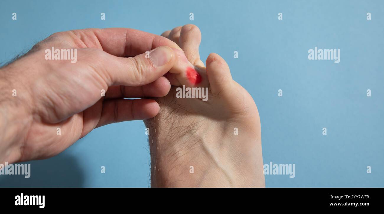 Callus on finger hi-res stock photography and images - Alamy