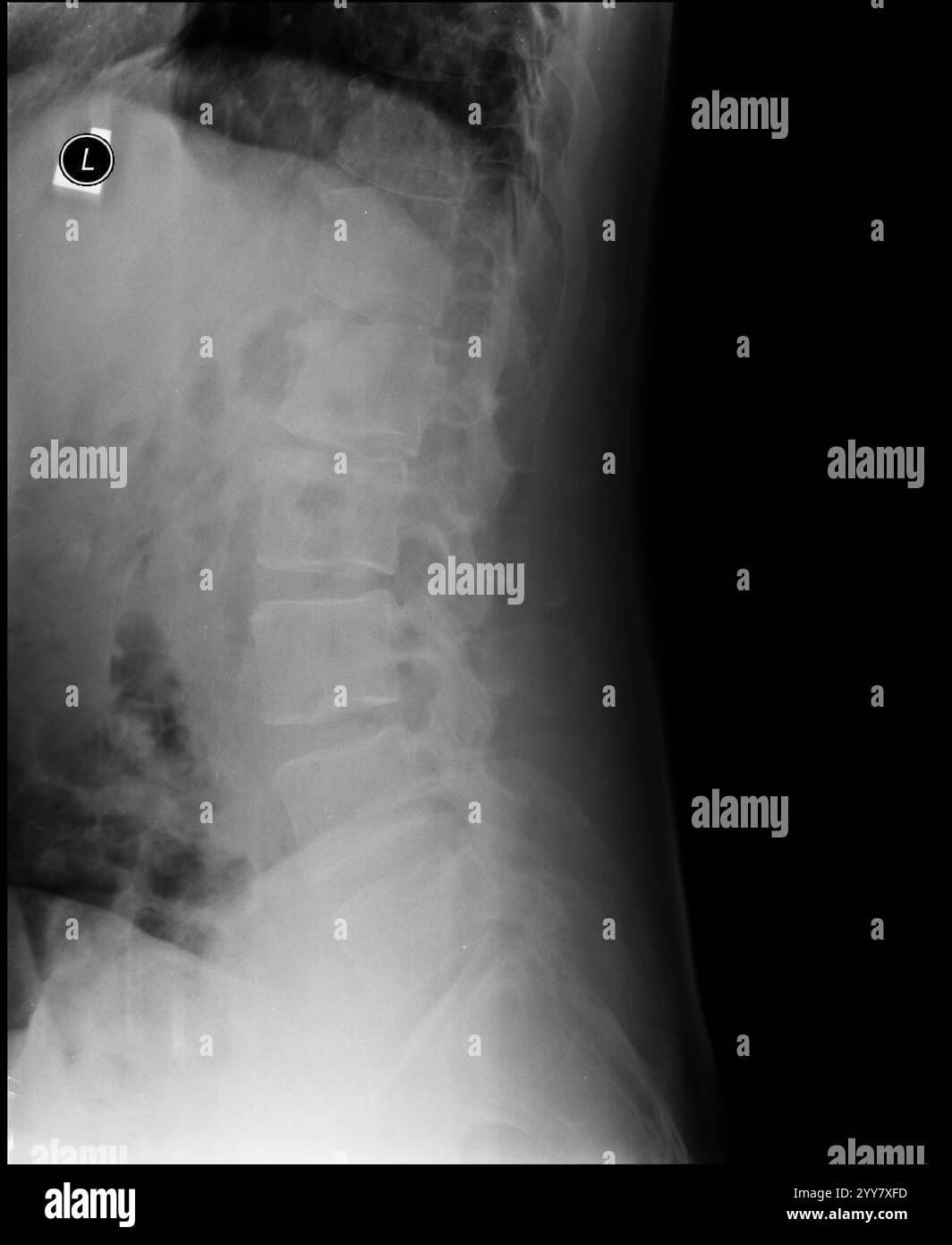 Lumbosacral spine x-ray. Lateral view. At levels L1-2 and L4-5, there ...