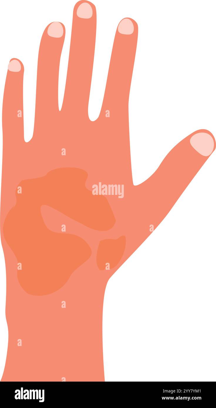 Skin diseases, contact dermatitis. Hand with scratches. Concept of ...