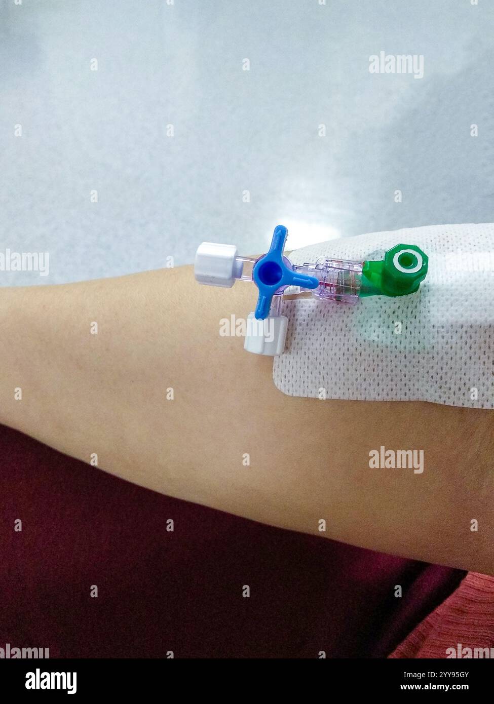 An intravenous catheter installed on a woman's arm for administering ...