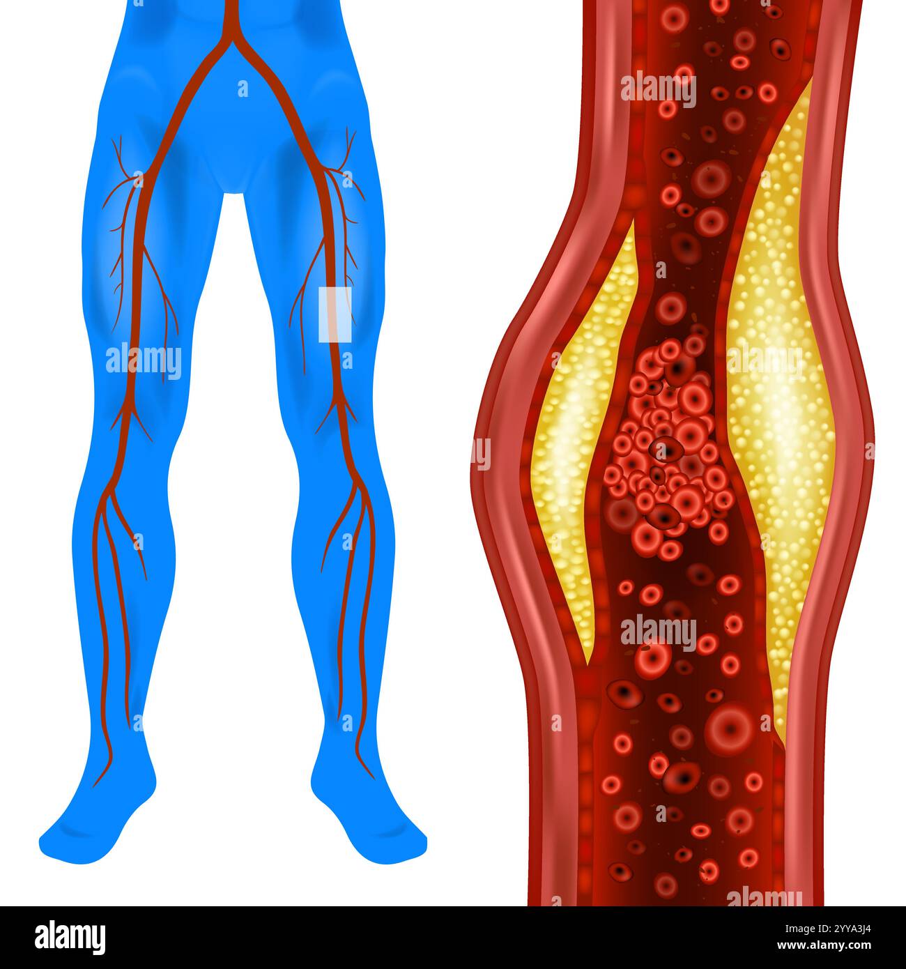Atherosclerosis in Leg Artery Illustration. Leg Artery Blockage Medical Illustration ...