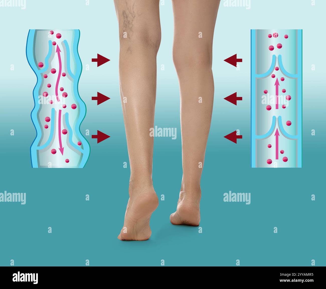 Varicose veins. Woman showing legs on turquoise gradient background ...