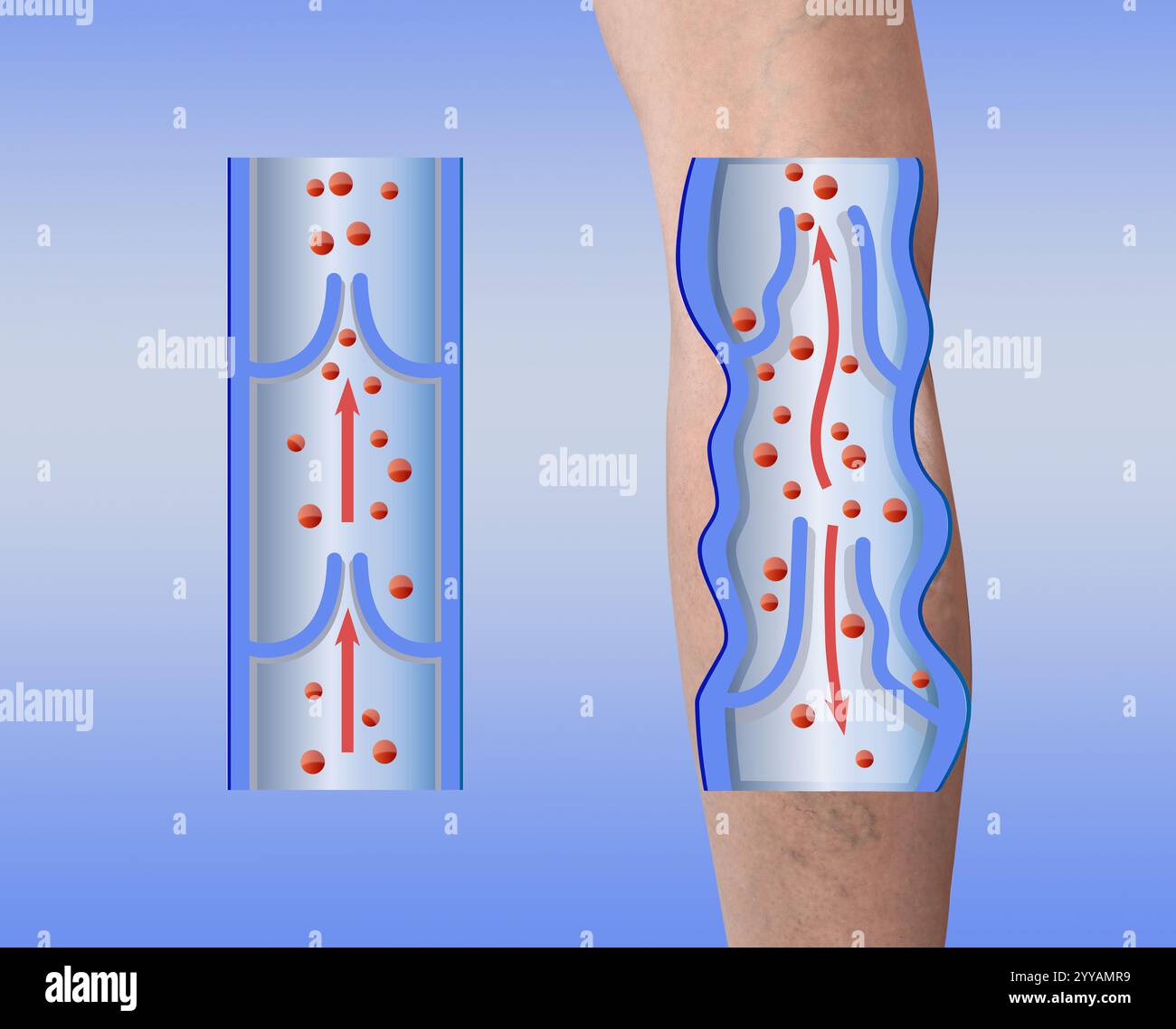 Varicose veins. Woman showing leg on light blue background, closeup ...