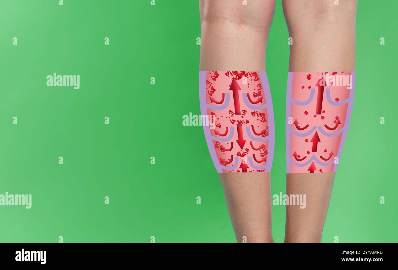 Varicose veins. Woman showing legs on green background, closeup ...