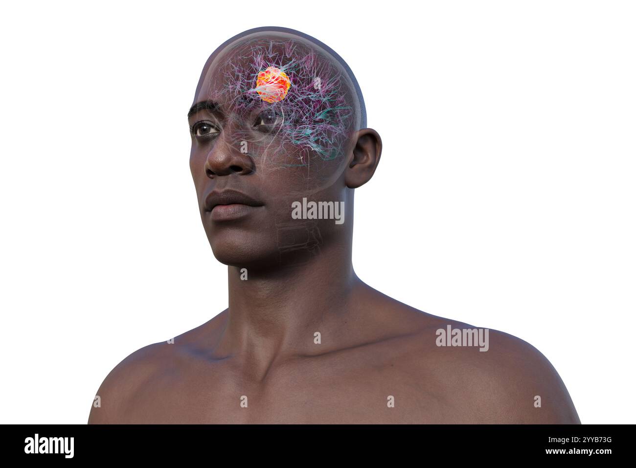 Computer illustration of a brain tumour Stock Photo - Alamy