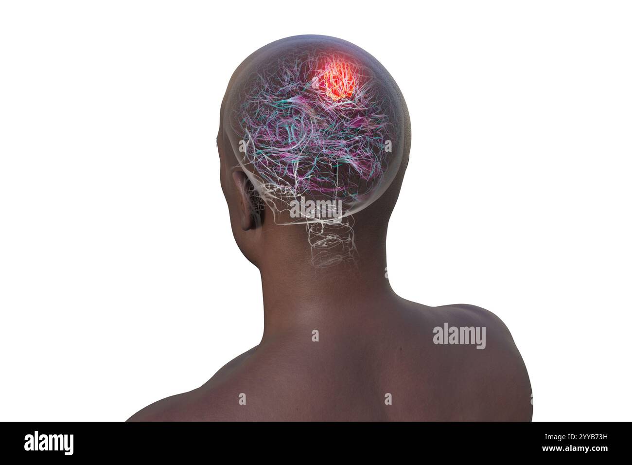 Computer illustration of a brain tumour Stock Photo - Alamy