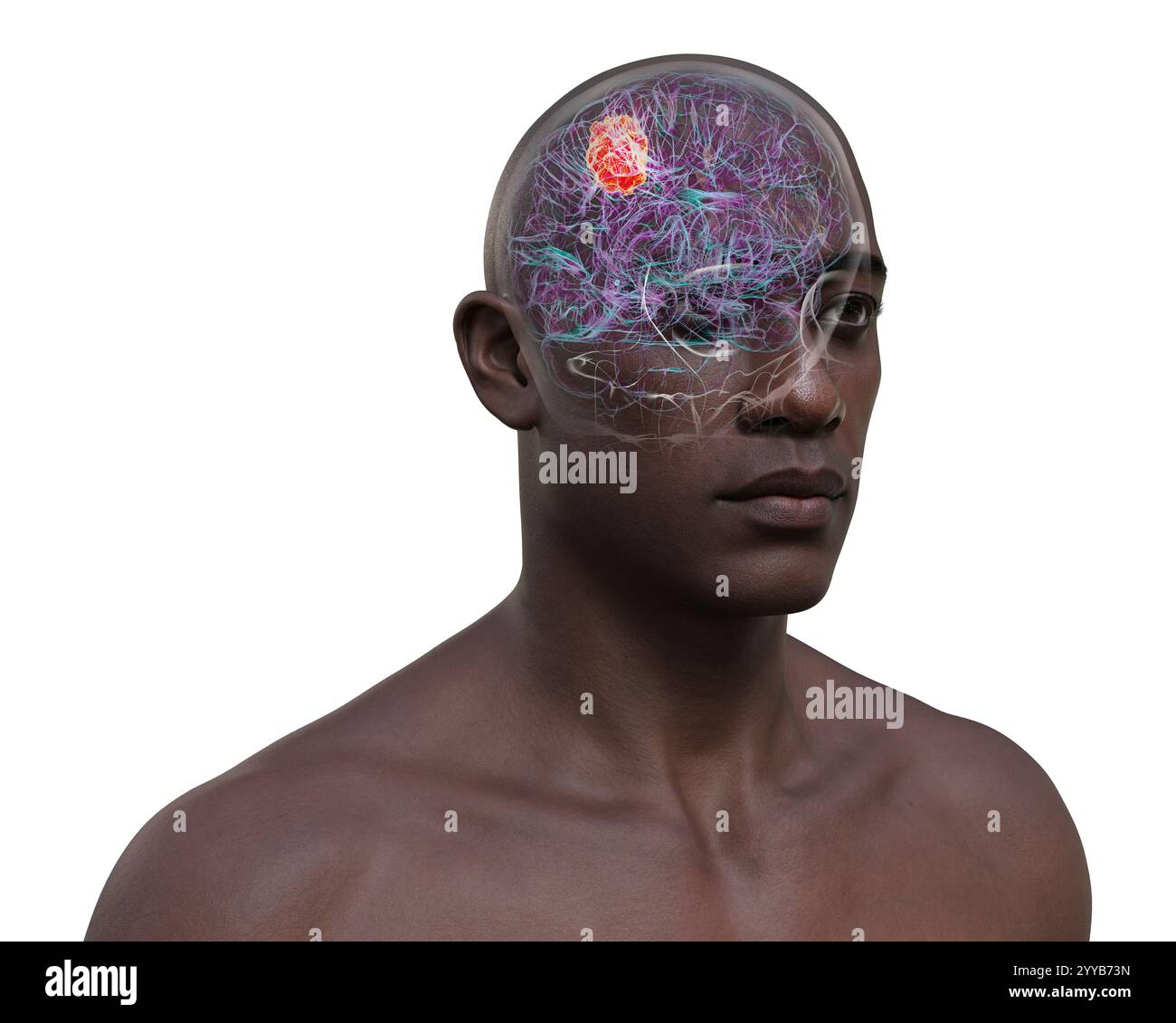 Brain tumour illustration meningioma hi-res stock photography and ...