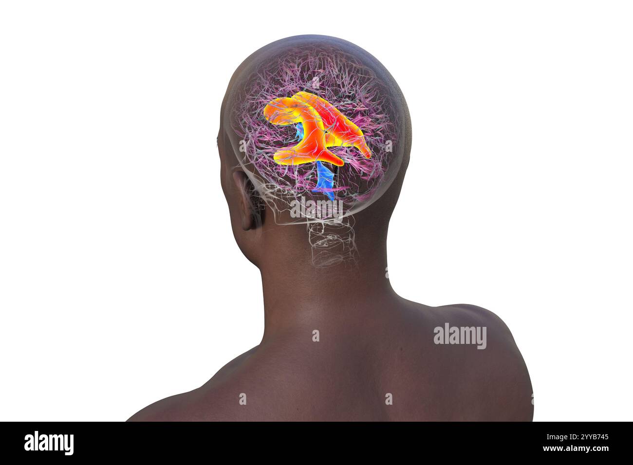 Computer illustration showing enlarged lateral ventricles ...