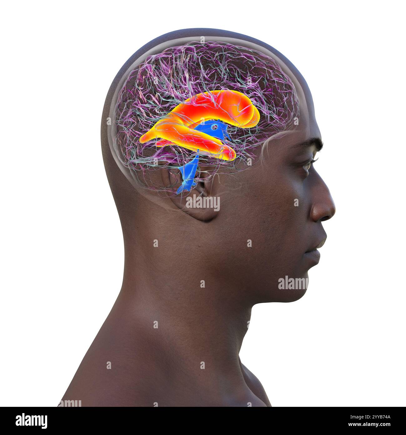 Computer illustration showing enlarged lateral ventricles ...