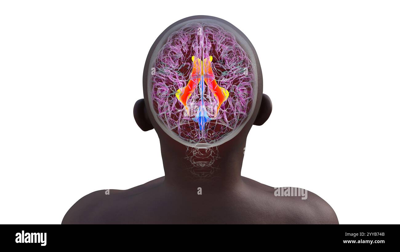 Computer illustration of the lateral brain ventricles, the largest ...