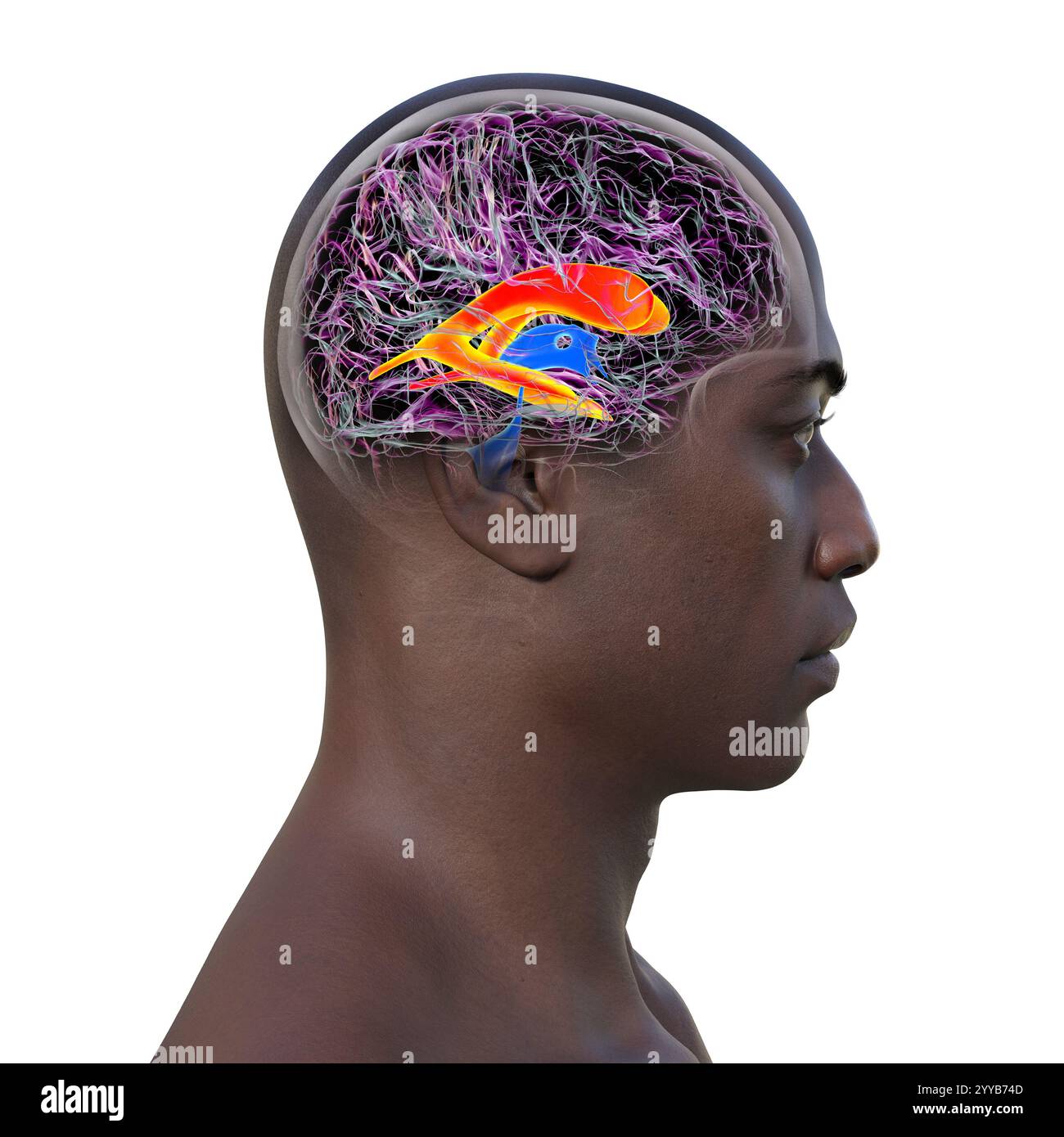 Computer illustration of the lateral brain ventricles, the largest ...