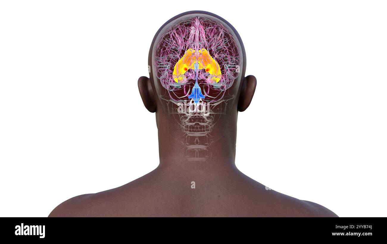 Computer illustration showing enlarged lateral ventricles ...