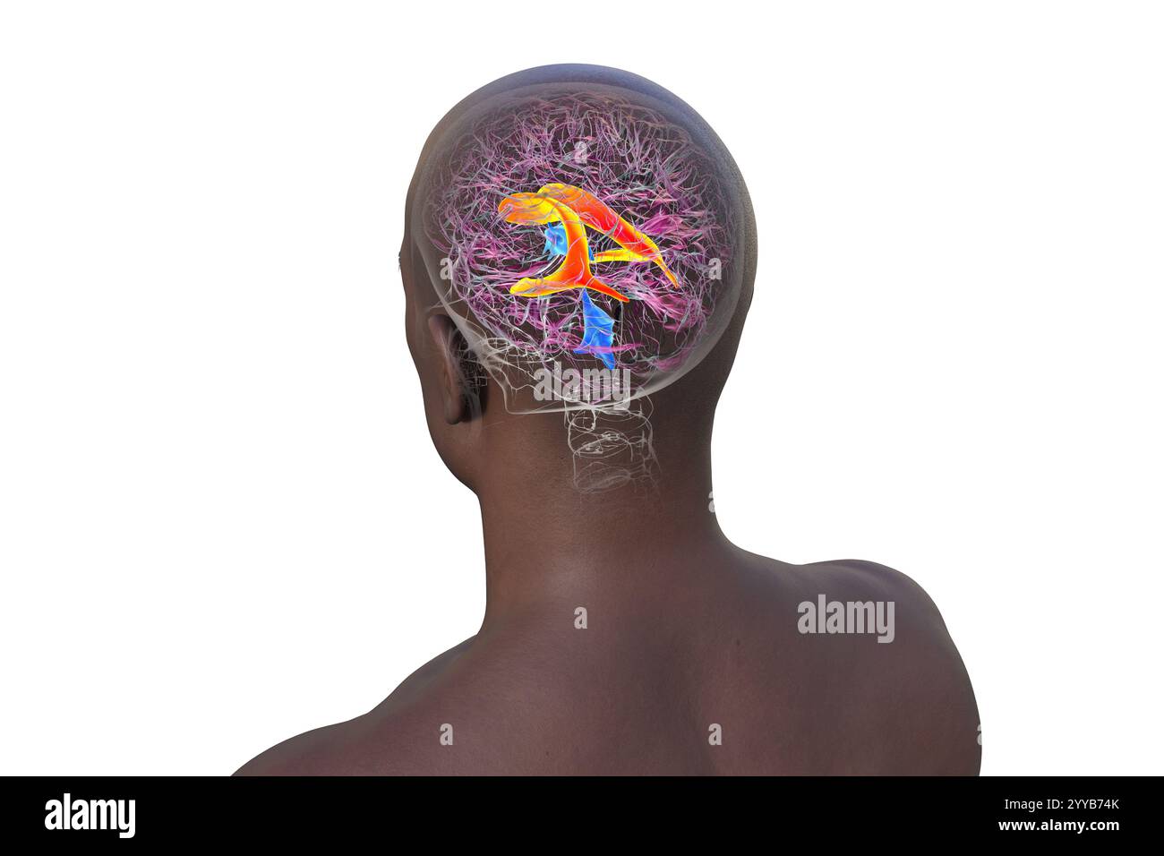 Computer illustration of the lateral brain ventricles, the largest ...