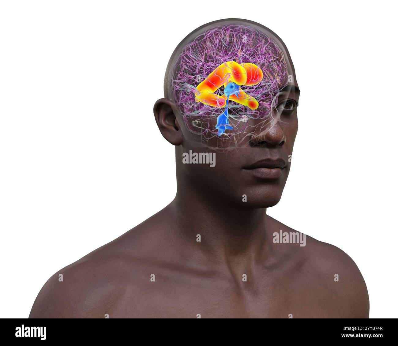 Computer illustration showing enlarged lateral ventricles ...