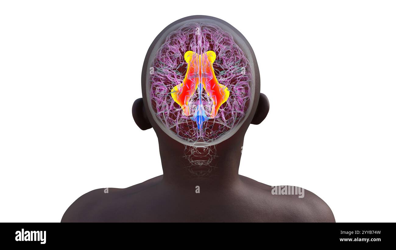 Computer illustration showing enlarged lateral ventricles ...