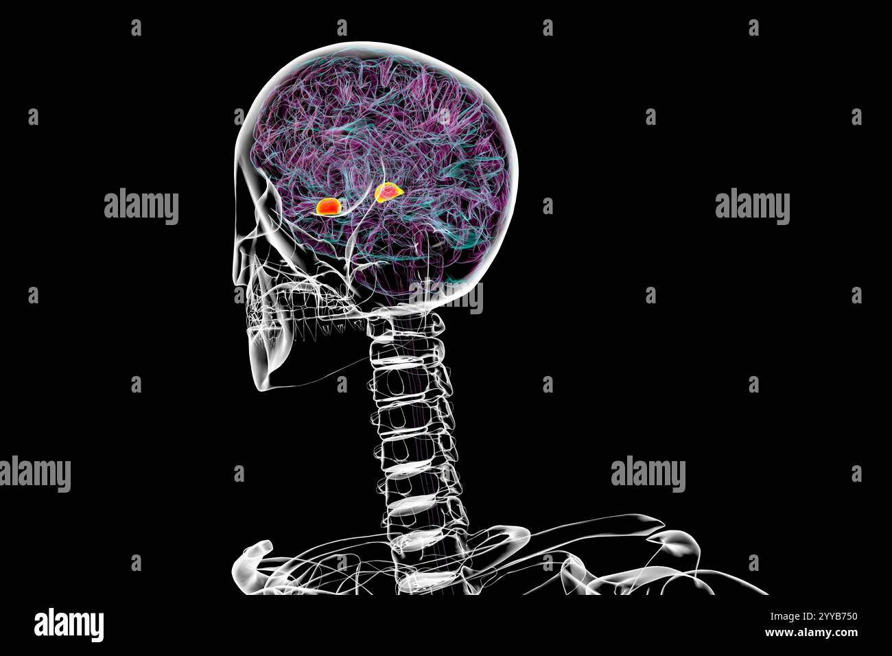 Human brain with the amygdala highlighted, computer illustration Stock ...