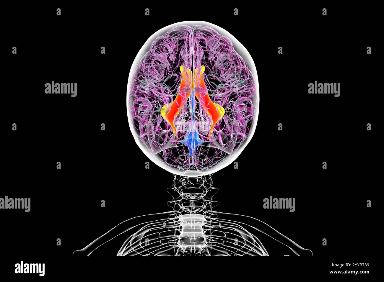 Computer illustration of the lateral brain ventricles, the largest ...