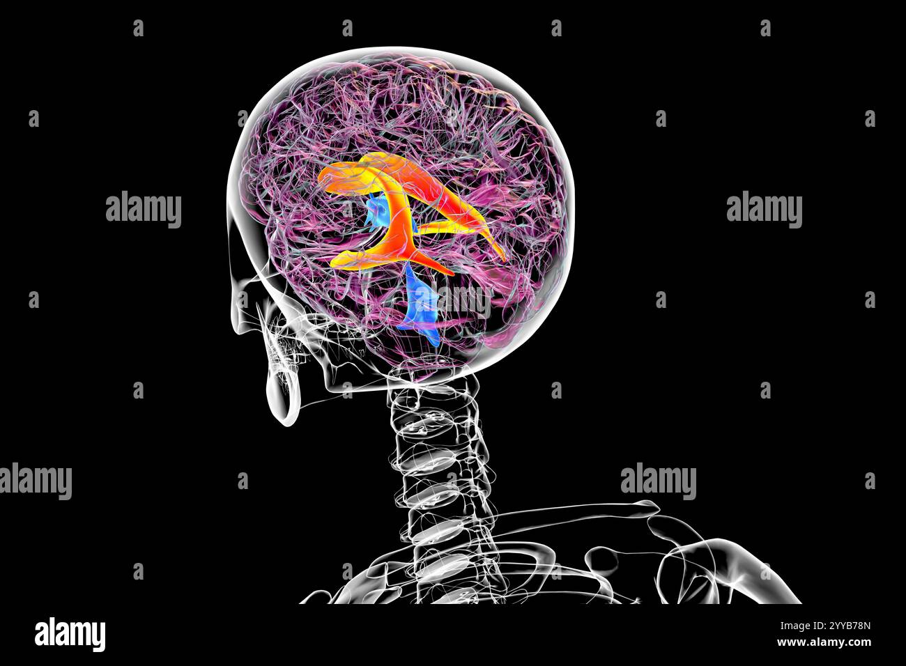 Computer illustration of the lateral brain ventricles, the largest ...