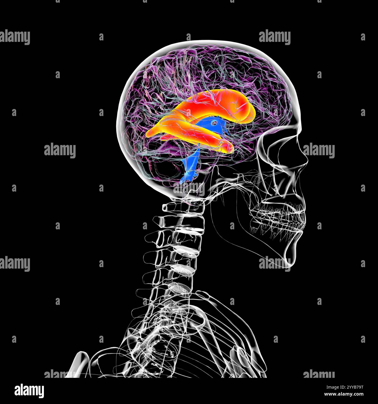 Computer illustration of enlarged lateral ventricles (hydrocephalus) of ...