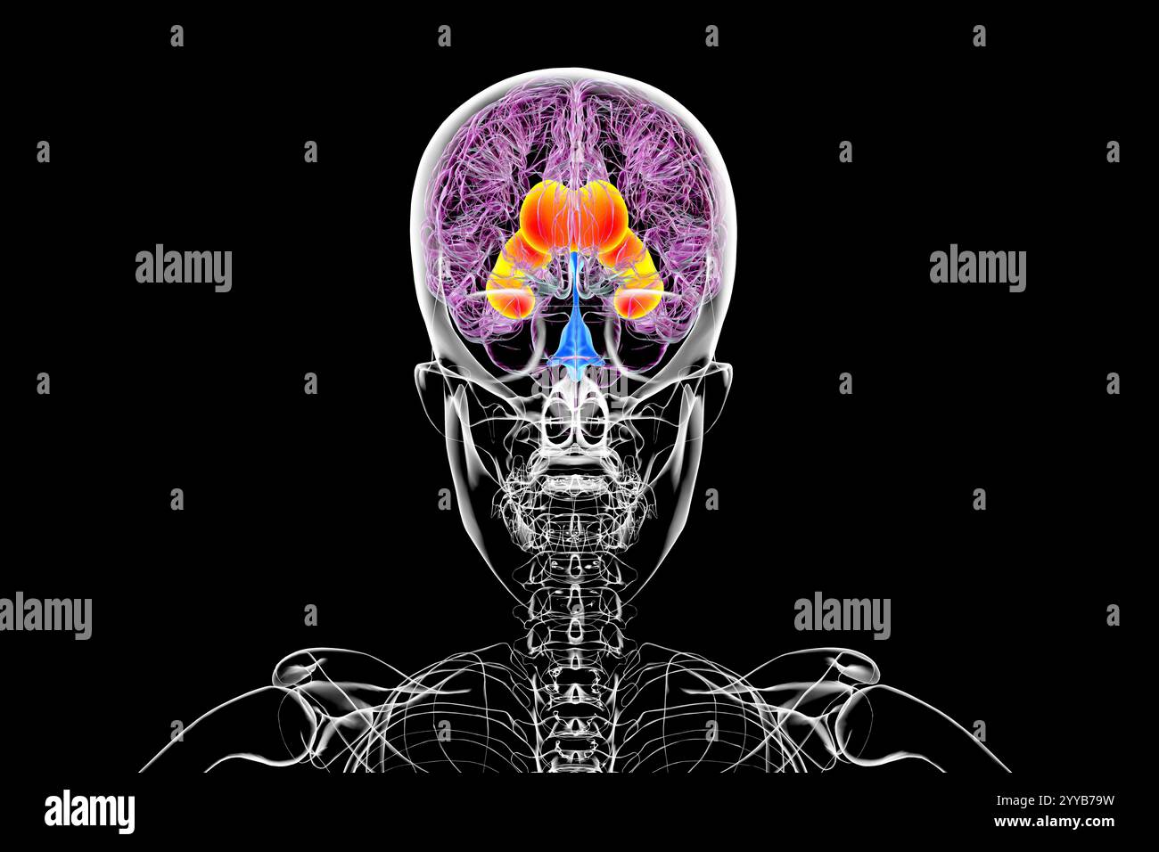 Computer illustration of enlarged lateral ventricles (hydrocephalus) of ...