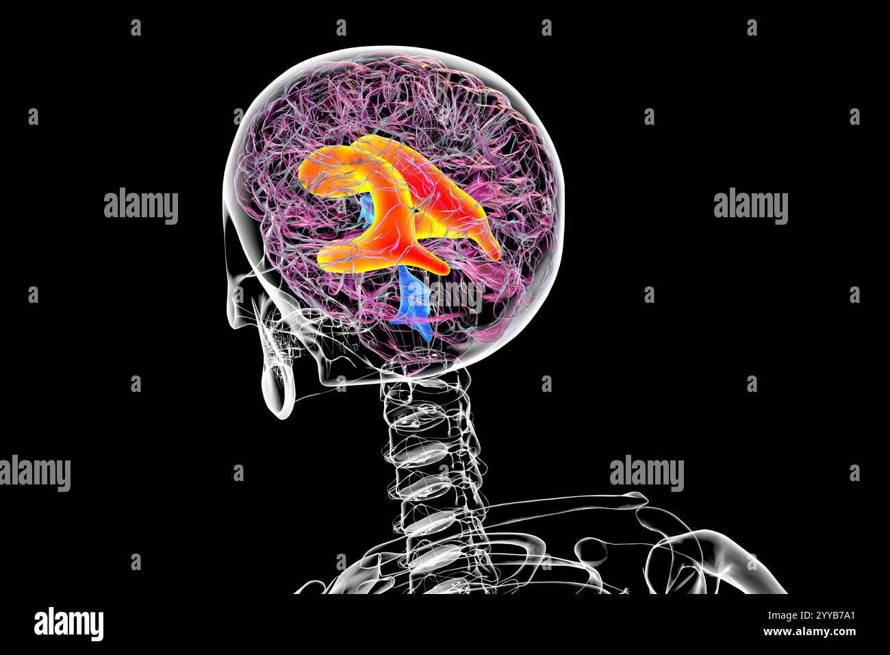 Computer illustration of enlarged lateral ventricles (hydrocephalus) of ...
