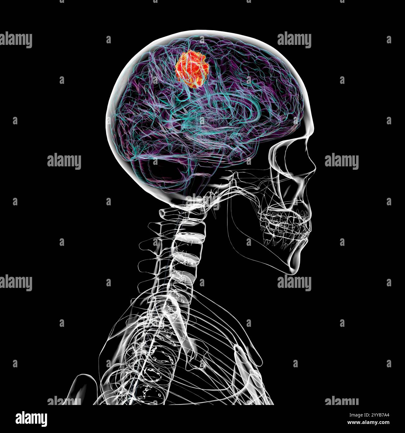Computer illustration of a brain tumour Stock Photo - Alamy