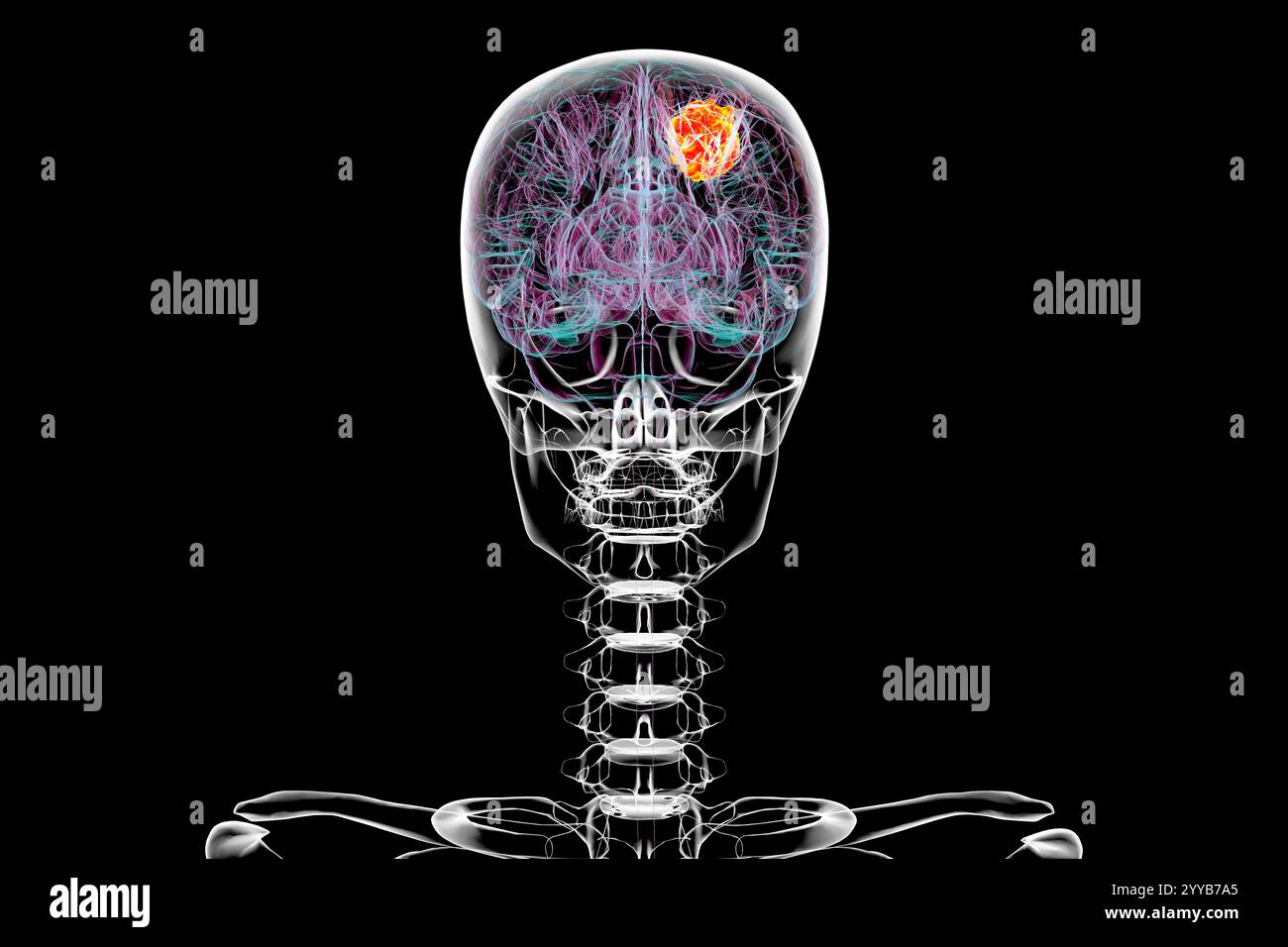 Computer illustration of a brain tumour Stock Photo - Alamy