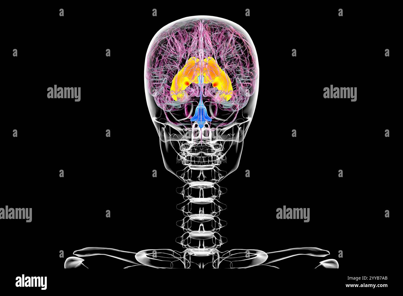 Computer illustration of enlarged lateral ventricles (hydrocephalus) of ...