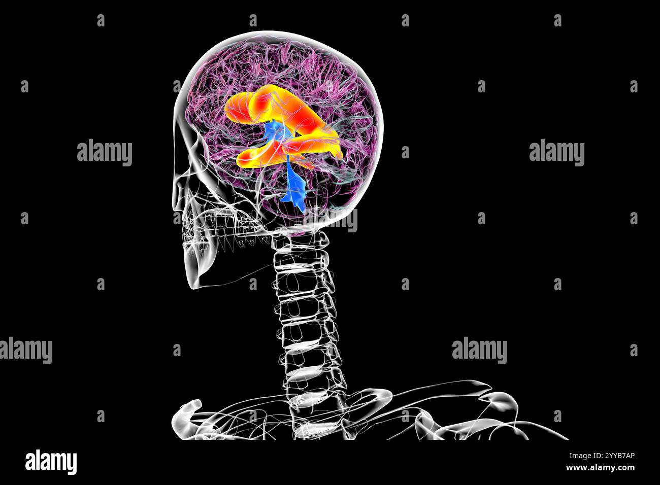 Computer illustration of enlarged lateral ventricles (hydrocephalus) of ...