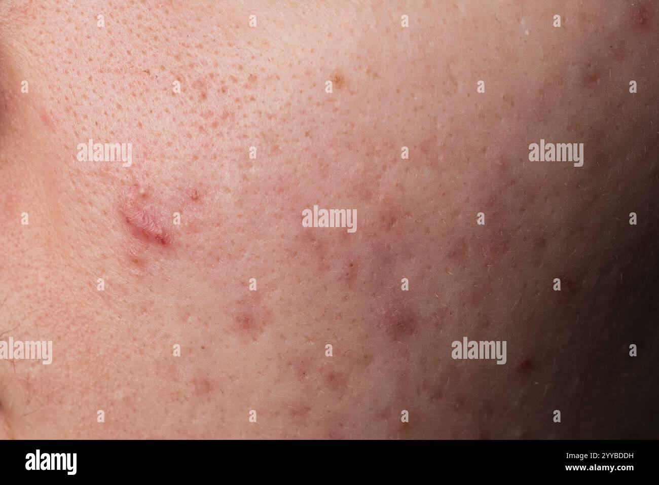 Skincare. Acne treatment. Face, skin, pimples. Girl with pimples ...