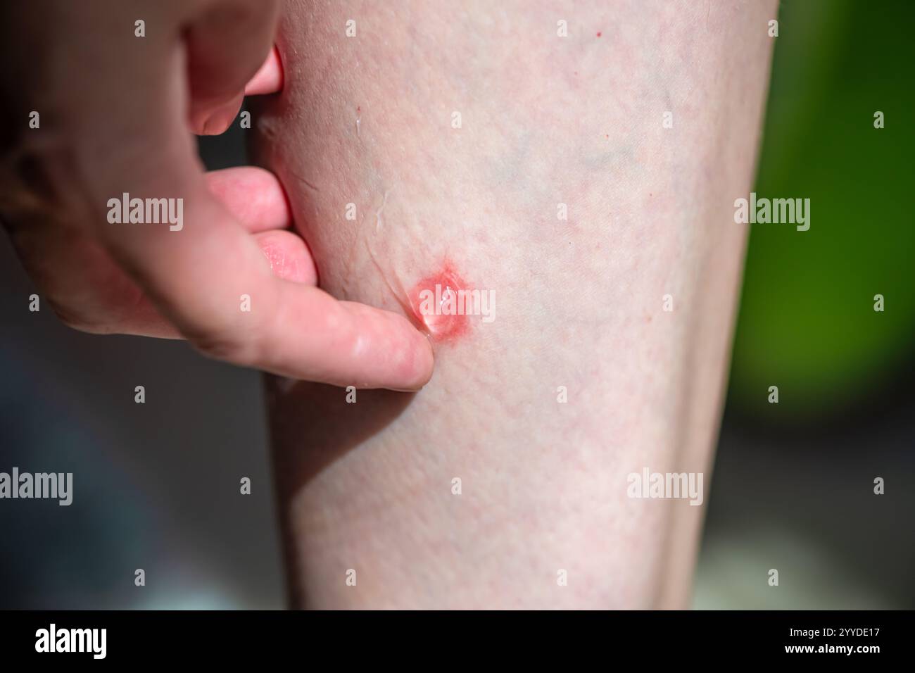 A bright bite from an insect on a person's leg, lubricated with a ...