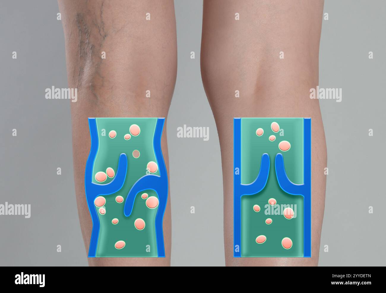 Varicose veins. Woman showing legs on grey background, closeup ...