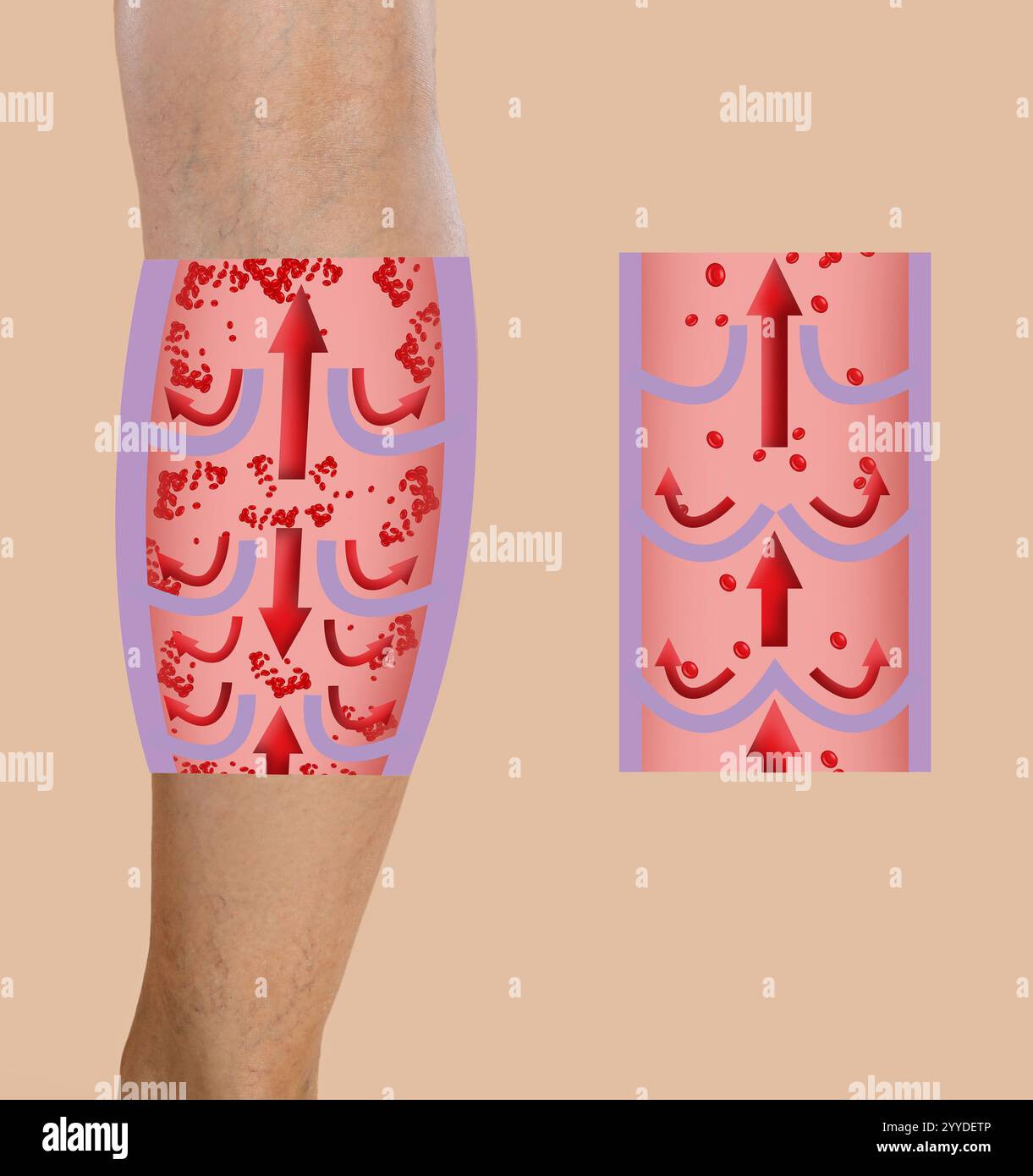 Varicose veins. Woman showing leg on beige background, closeup ...