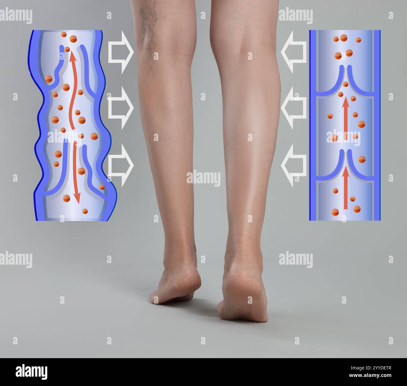 Varicose veins. Woman showing legs on grey background, closeup ...