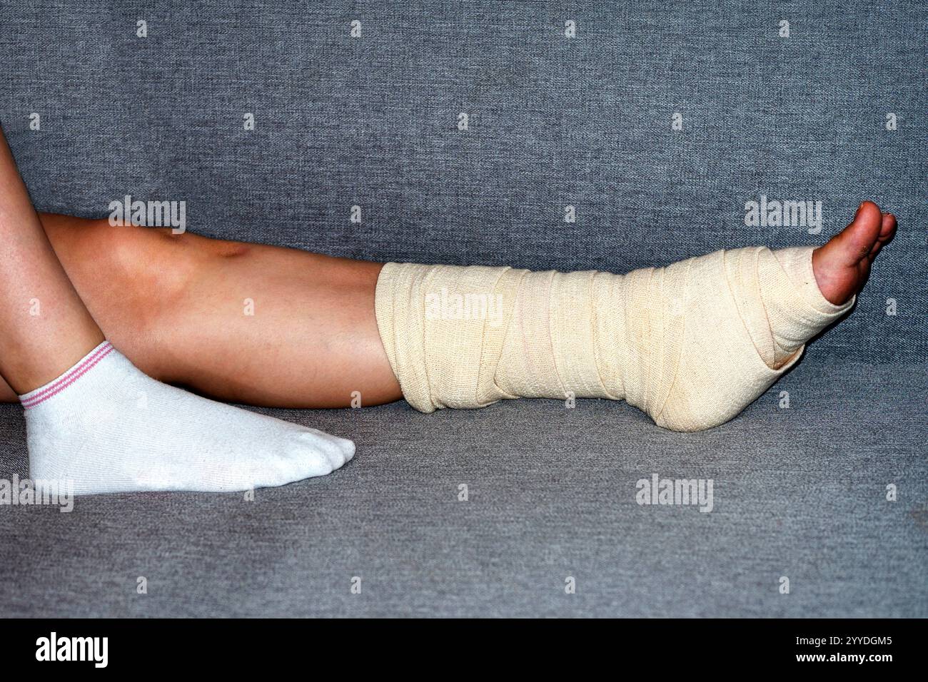 Woman with broken leg. female bandaging foot on the floor. The concept ...
