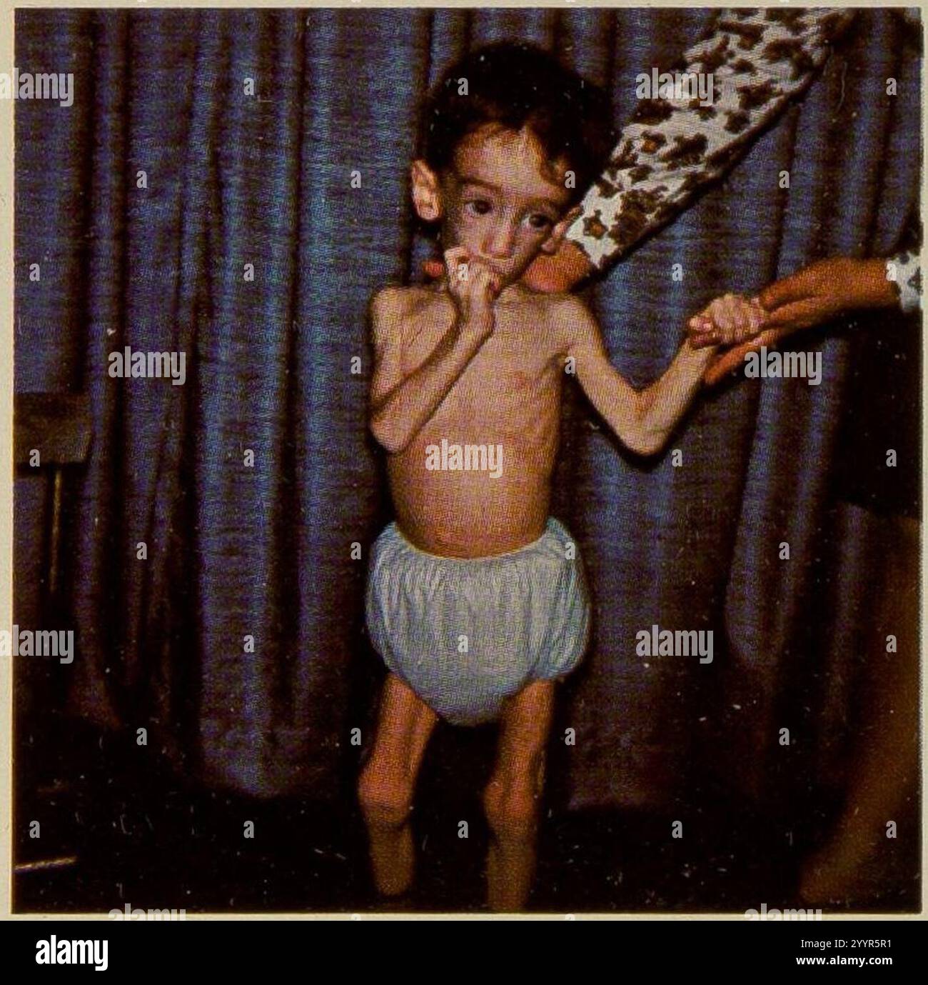 Diencephalic Syndrome 2 Stock Photo - Alamy