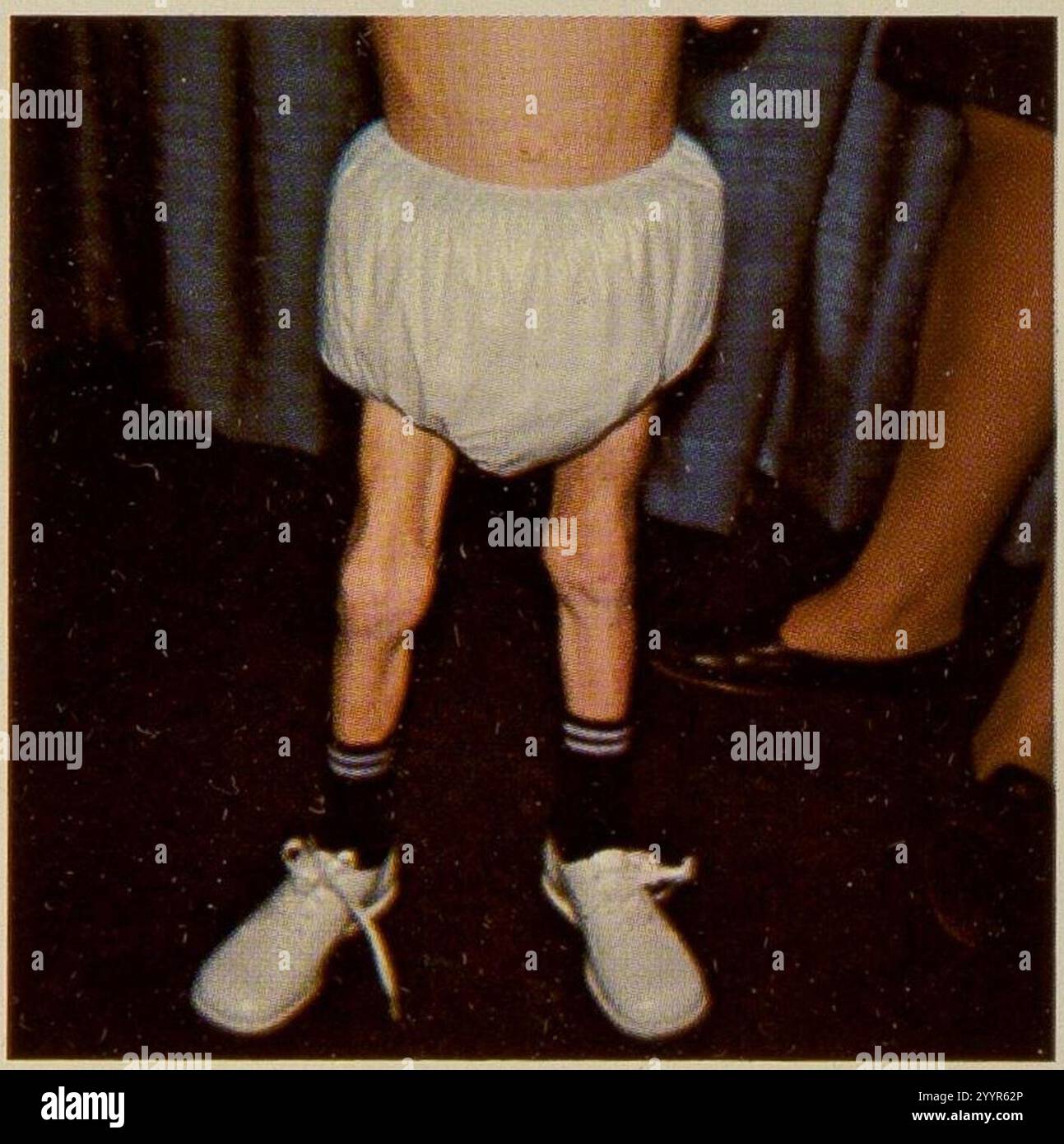 Diencephalic Syndrome 4 Stock Photo - Alamy