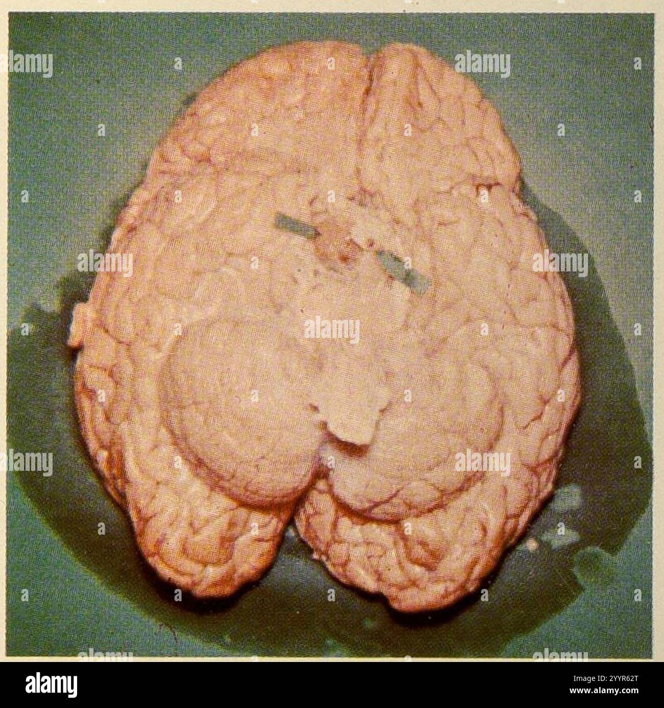 Diencephalic Syndrome 5 Stock Photo - Alamy