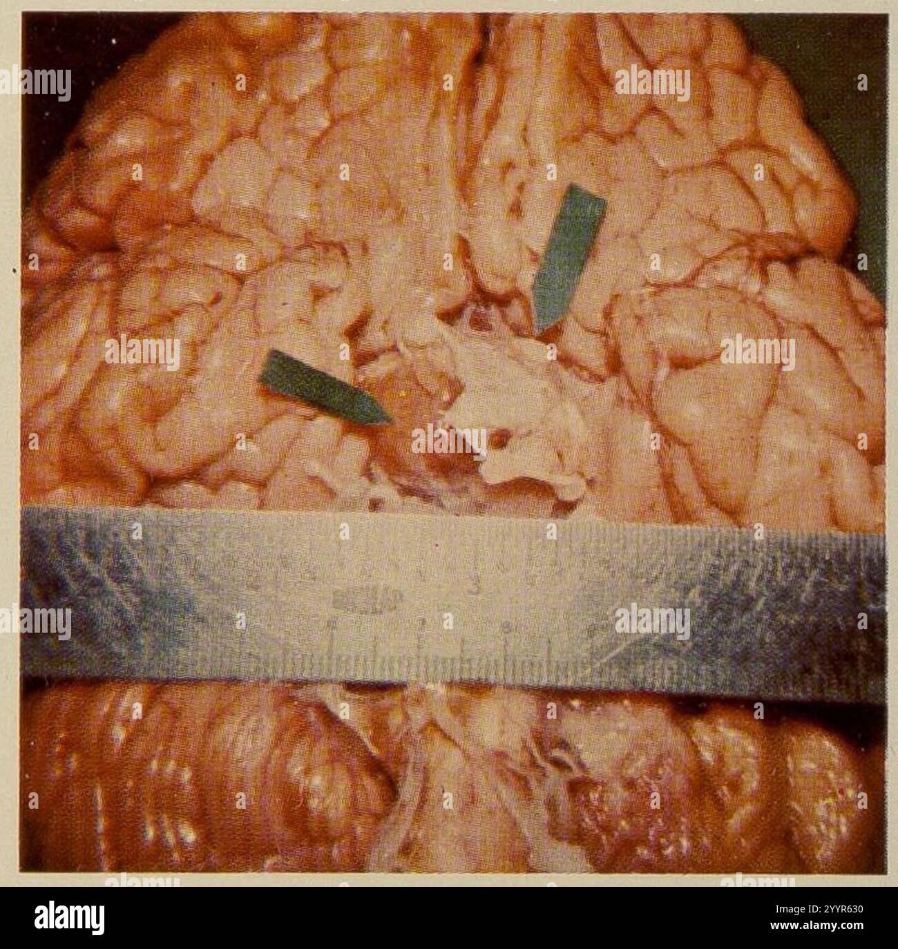 Diencephalic Syndrome 6 Stock Photo - Alamy