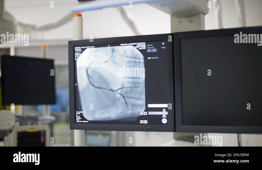 Monitor screen in radiology during heart surgery Stock Video Footage ...