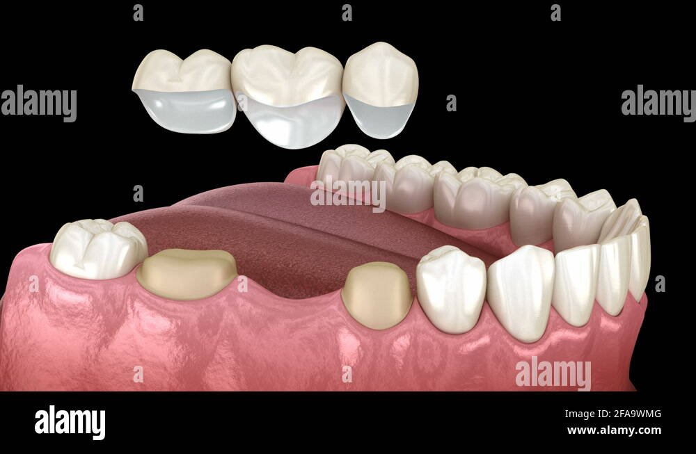 Dental bridge of 3 teeth over molar and premolar Stock Video Footage ...