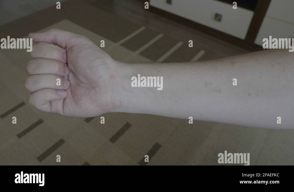 Young man looking on his arm with smallpox viral disease marks on skin ...